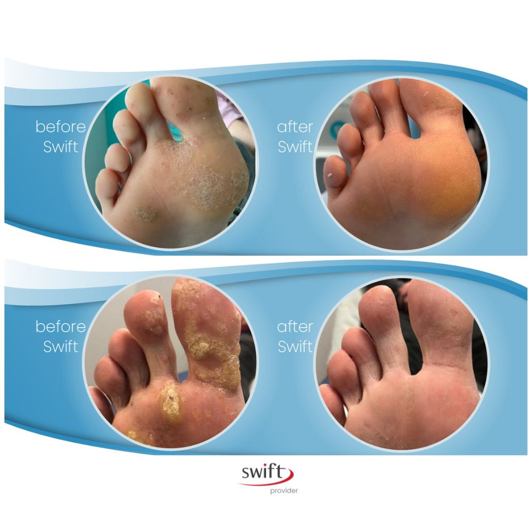 SWIFT Verruca Treatment | Best Verruca Removal Treatment | Say Goodbye ...